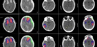 This AI tool automatically identifies different types of brain injury ...